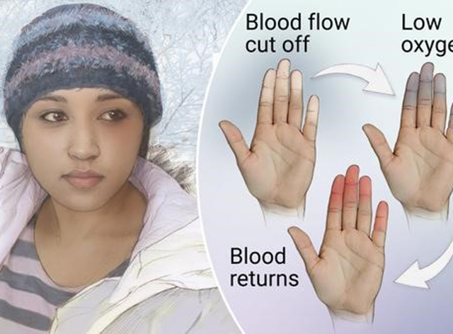 Finger Cut Off Circulation